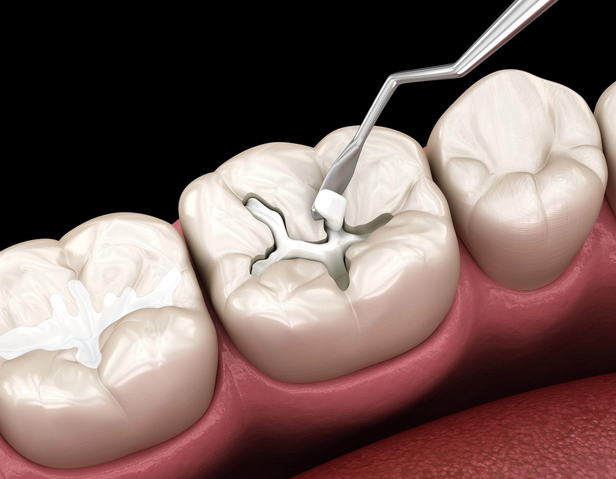 Best Tooth Filling for Cavities: Choosing the Right Material for Your Smile